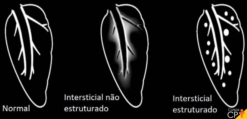 Doenca Pulmonar Intersticial Raio X